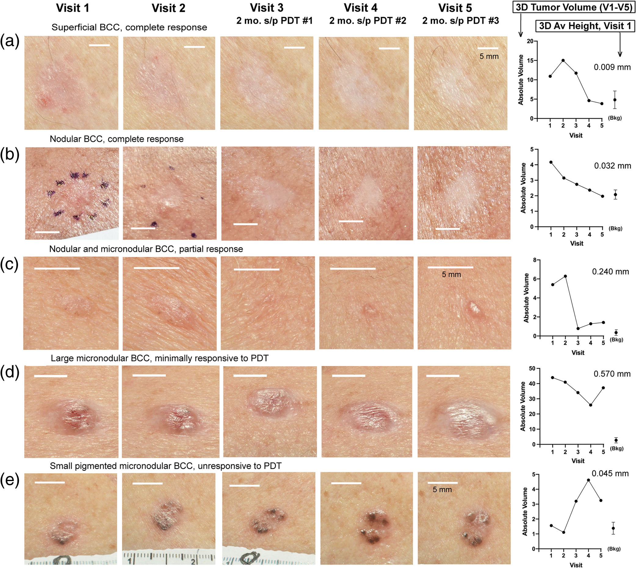 3D photogrammetry quantifies the size of basal cell carcinoma lesions ...
